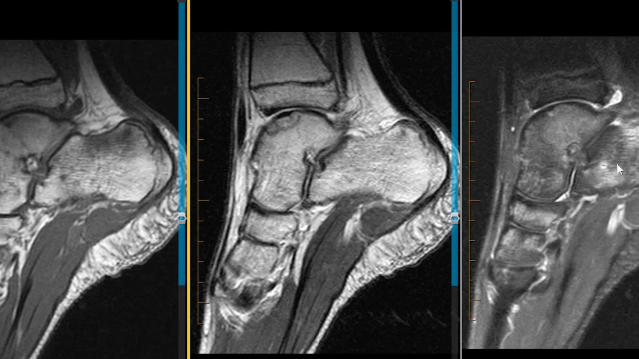 Foot And Ankle Mri Practice Cases Radiology Course Mri Online Is Now Medality