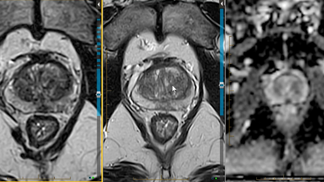 Pi Rads Assessment Peripheral Zone Mri Online Is Now Medality